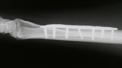 Ulnar Shortening Osteotomy Creative Medical Designs, Inc.